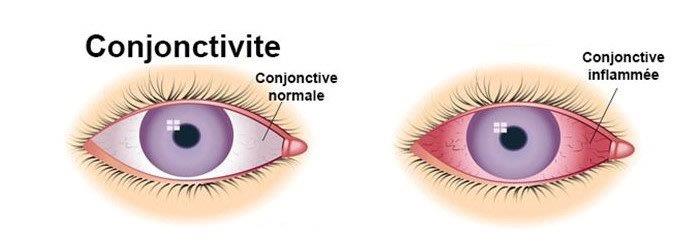 Conjonctivite - Pharmacie Aubret Vial